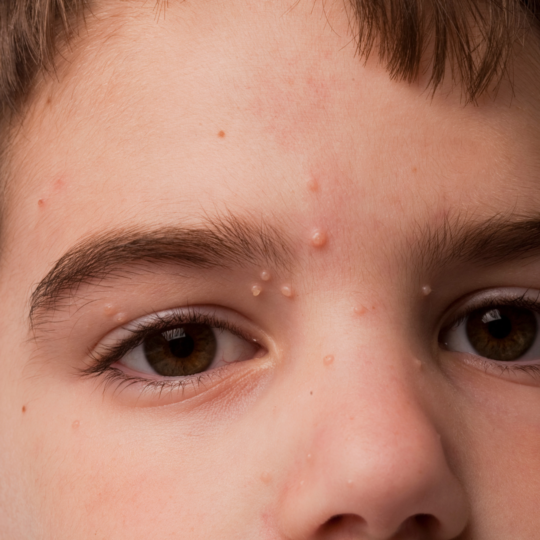 MOLUSCO – Racderma